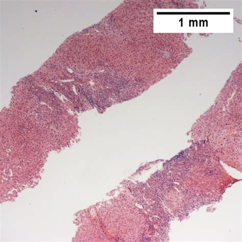 Autoimmune Hepatitis Libre Pathology