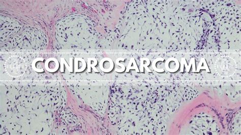 Condrosarcoma Myd Medicine Udocz