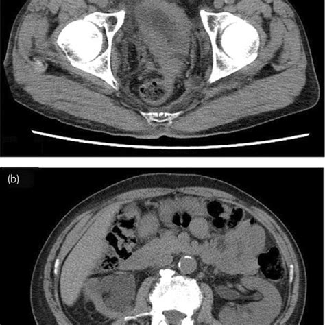 Ct Shows A Thickened Bladder Wall And Contiguous Tumor Extending Into Download Scientific
