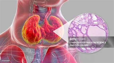 Endemic Goitre Of Thyroid Gland 3d Illustration High Res Vector Graphic Getty Images