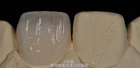 烤瓷贴面仿真修复