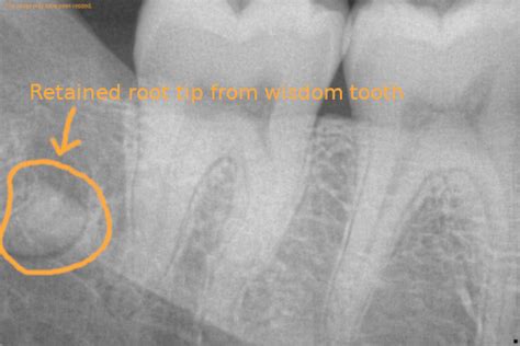 Are Retained Root Tips A Problem 1311 Jackson Ave Dental Dentist