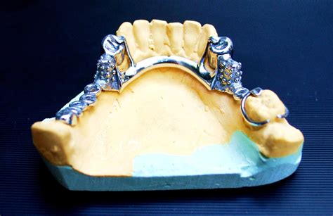 Gonzalo Mendiberry Técnico Dental Esqueleto de Cromo Cobalto con attach