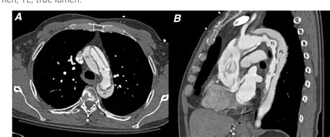 Figure 4 From The Role Of Multidetector Row Ct In The Diagnosis Classification And Management