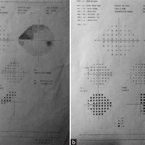 Visual Field 24 2 A Od Wide Upper Nasal Step Md −10 33 B Os Download Scientific Diagram