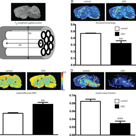 Decreased Fractional Anisotropy And Myelin Total Water Fraction