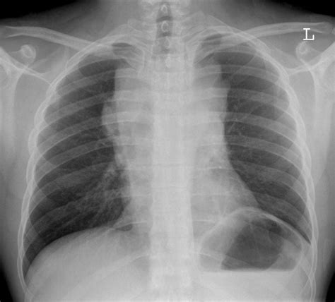 Cxr Case 023 • Litfl • Chest X Ray Self Assessment Quiz