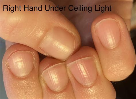 Fungus Or Something Else Ringrowntoenails