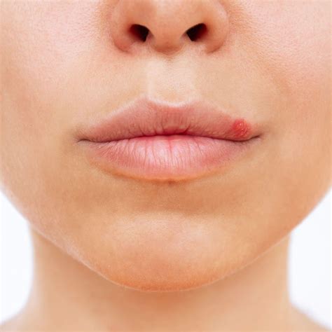 Cold Sore After Lip Blush Cause Prevention Treatment
