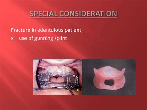 Mandibular Fracturepptx