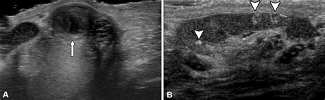 Gamut Of Extratesticular Scrotal Masses Anatomic Approach To