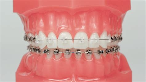 Moonee Ponds Orthodontics Are Clear Or Metal Braces Better