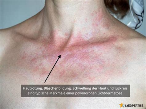 Sonnenallergie Ursachen Symptome Behandlung