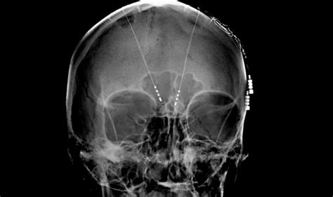 Subcallosal Cingulate Deep Brain Stimulation For Treatment Resistant Unipolar And Bipolar Depression