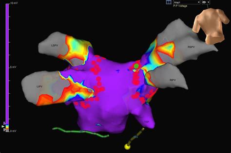 Left Atrium Voltage Map In A Posteroanterior View The Red Dots Download Scientific Diagram