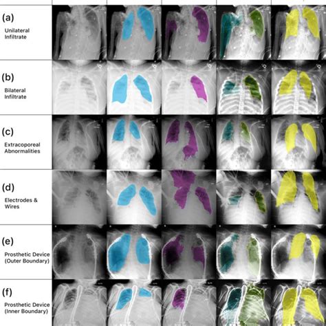 Segmentation With The Stacked Active Contour Model A An Example Download Scientific Diagram