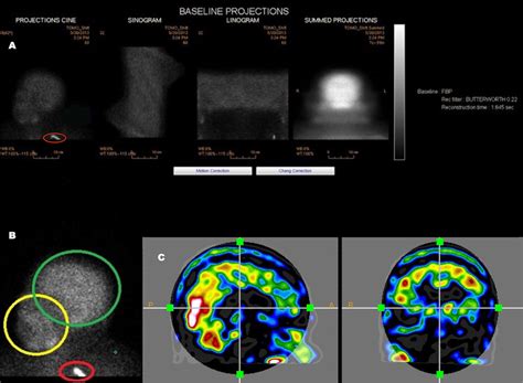An Example Of A Poorly Executed Perfusion Spect Scan A Projection Download Scientific