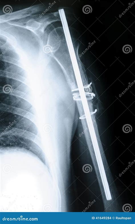 Humerus Proximal Superior View Royalty Free Stock Image Cartoondealer Com