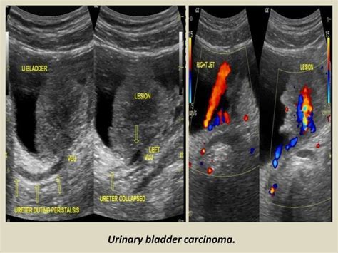 Presentation1pptx Ultrasound Examination Of The Urinary Bladder And