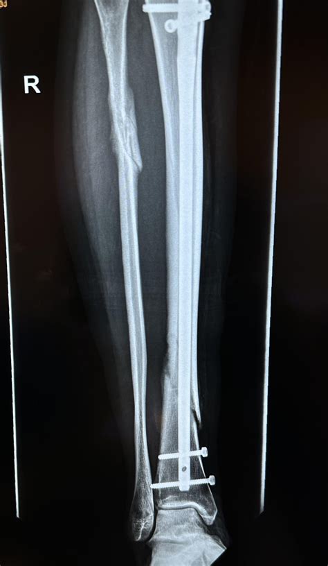 Broke My Tibia And Fibula On Jan 26th My Doctor Told Me Hes Never Seen Broke My Tibia And Fibula On Jan 26th My Doctor Told Me Hes Never Seen