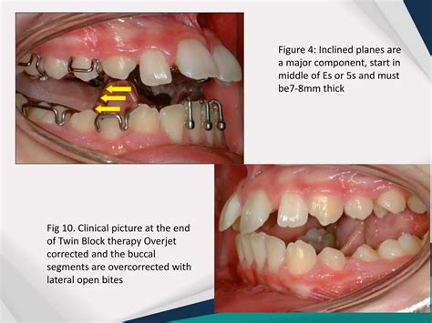 Twin Block Appliance In Orthodontics Pptx