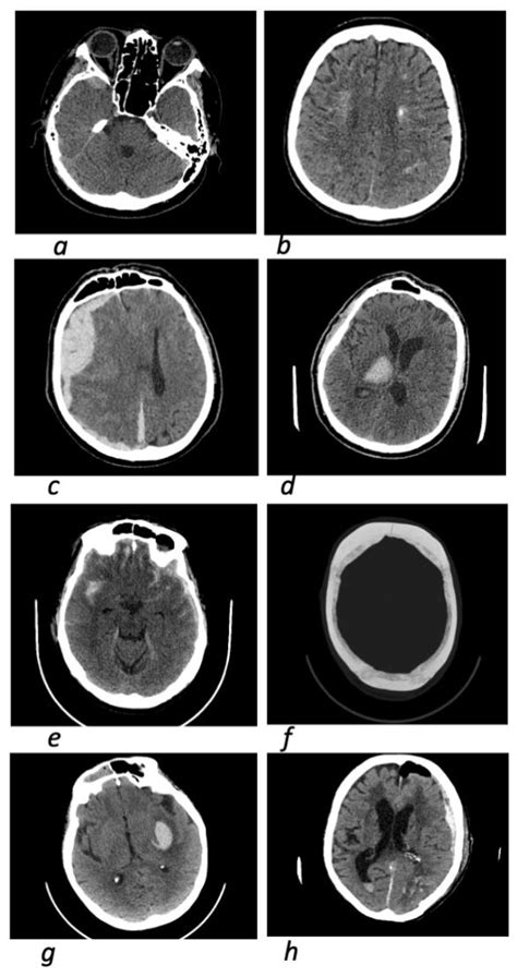 Expanded Brain Ct Dataset For The Development Of Ai Systems For Intracranial Hemorrhage