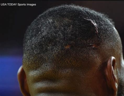 Lebron James Hair Transplant Before And After Analysis