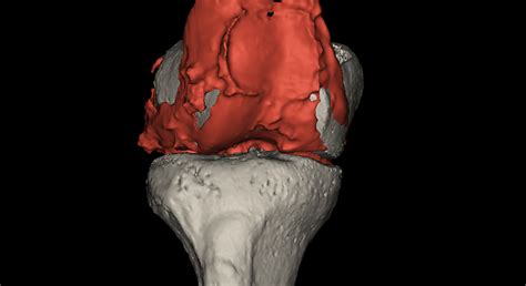 Database Of Patient Specific Anatomical Models For Condyle Lesions Restore