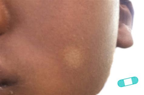 Pityriasis Alba Kind Pityriasis Alba Pics Alba Home Remedies Treatment