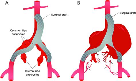 Vascular Illustration A Aorto Bifemoral Repair With Bifurcated Download Scientific Diagram