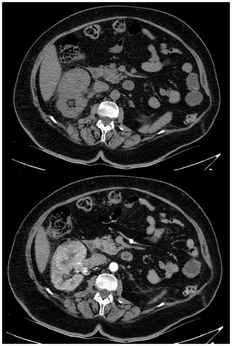 Metachronous Rapidly Growing Papillary Type 2 Renal Cell Carcinoma