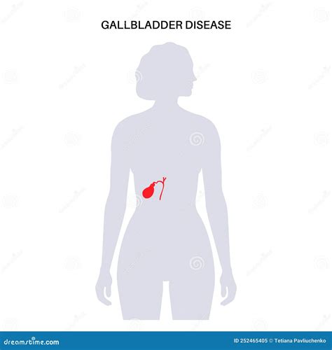Gallbladder Diseases Infographics Gallstone Disease Cancer Acute Cholecystitis Cholangitis