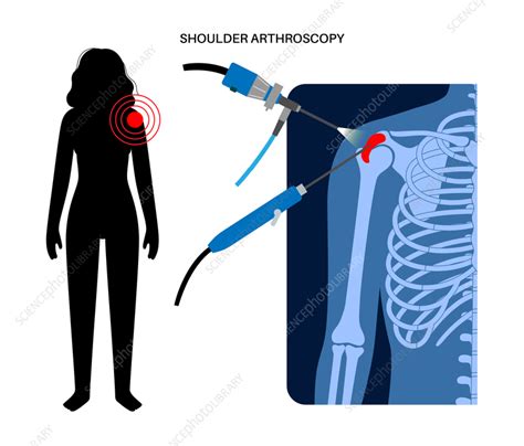 Shoulder Arthroscopy Procedure Illustration Stock Image F0428265 Science Photo Library