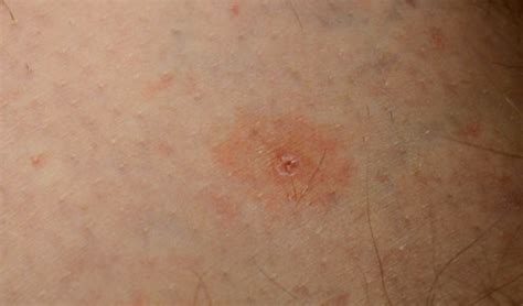 Tick Bites