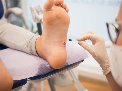Warts On Your Feet Symptoms And Causes Of Plantar Warts Foot And Ankle Group