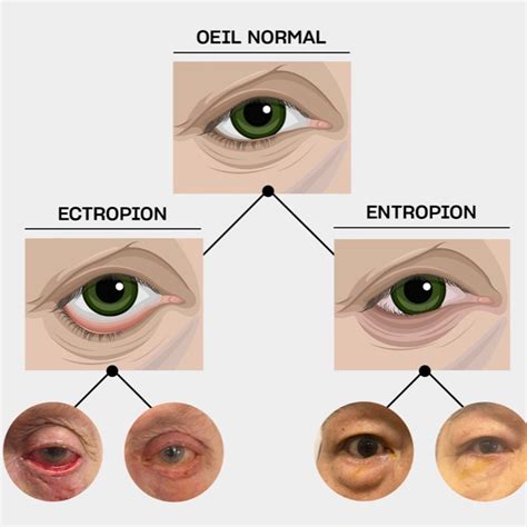 Entropion Ectropion Pathologies Centre Dophtalmologie Ryad