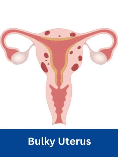 What Is Bulky Uterus And Why Does It Occur Aastha Fertility Center