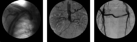 Follow Up Angiography For A Patient Who Underwent Extra Anatomic