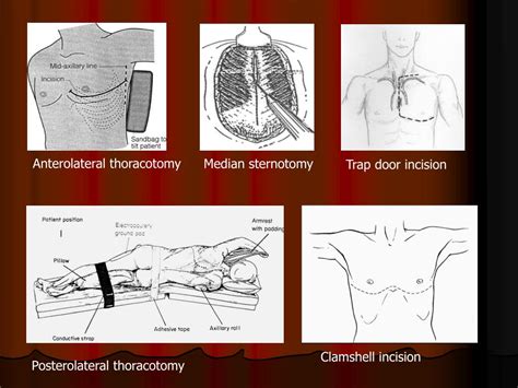 Clamshell Thoracotomy Cpt Code At Sara Gosman Blog