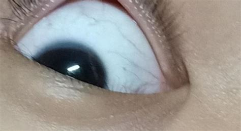 What Is This Gray Thing On My Eye Im Only R Optometry