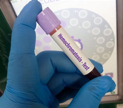 Hlab27 And Hfe Gene Tests Brought In House South West London Pathology