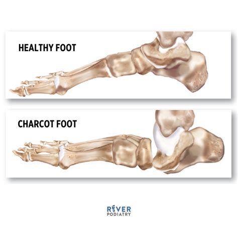 Call Today For Your Appointment River Podiatry I The Best Foot And Ankle Care In Nynj