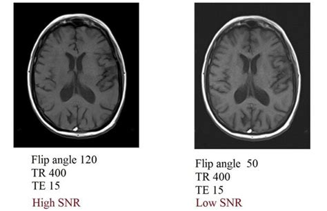Signal To Noise Ratio Snr In Mri Factors Affecting Snr