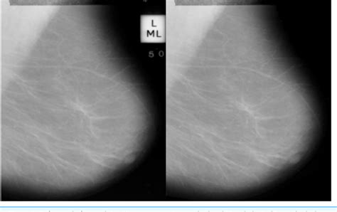 Figure 1 From Enhancing Early Breast Cancer Diagnosis Through Automated Microcalcification