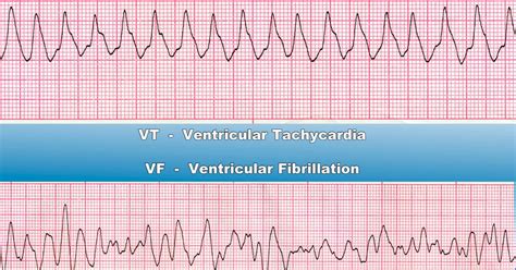 Tachycardia Manhattan Cardiology Manhattan Ny