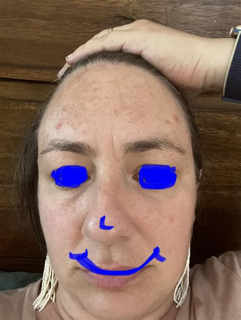 Whats Missing To Correct Redness Hyperpigmentation And Light Post Partum Acne 40f R