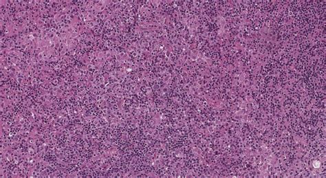 Ebv Positive Diffuse Large B Cell Lymphoma Ottawa Atlas Of Pathology