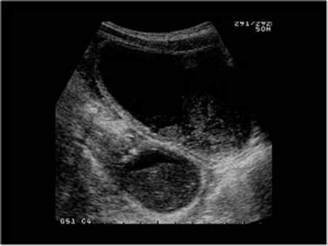 Abdomen And Retroperitoneum 1 5 Appendix Case 1 5 3 Complicated Appendicitis Ultrasound Cases