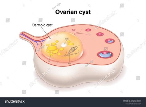 Dermoid Cyst Cross Section Vector Ovarian Stock Vector Royalty Free