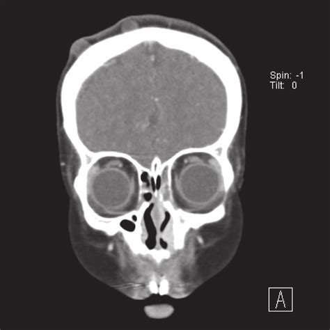 Histopathologic Examination Of The Nodules On The Scalp Shows A Cystic Download Scientific